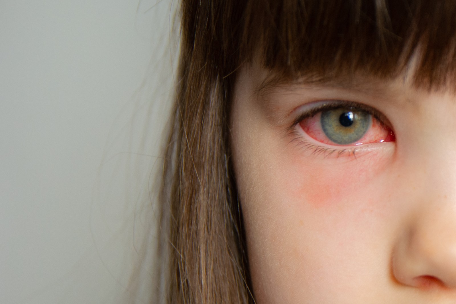 Niños y ojos rojos: la principal causa es la conjuntivitis